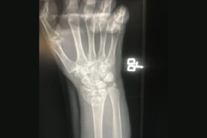 Orthopedic Health Care | Dr. Sean Thompson Bone & Joint Surgeon